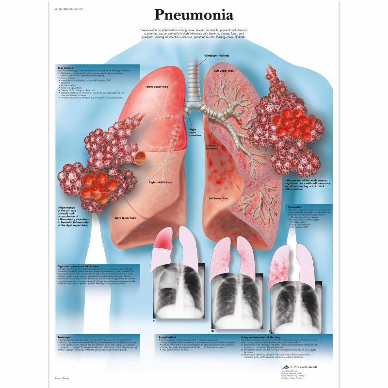 Pneumonia Chart - LabWorld.co.uk